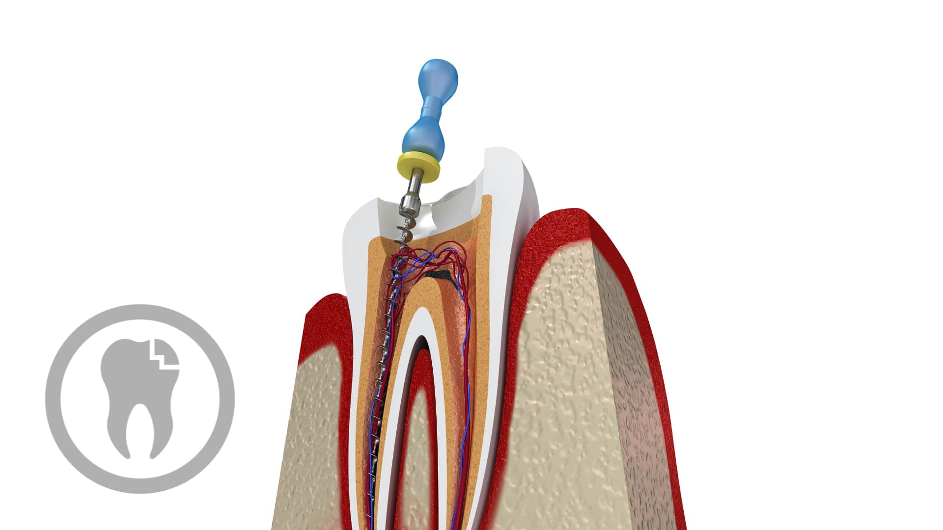 Revealed! The Untold Truth About Endodontics: Save Your Tooth and Your ...